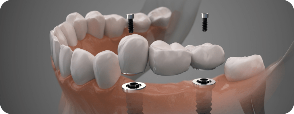 Mise en Charge Immédiate | Implants dentaires | Dentistes à Nîmes